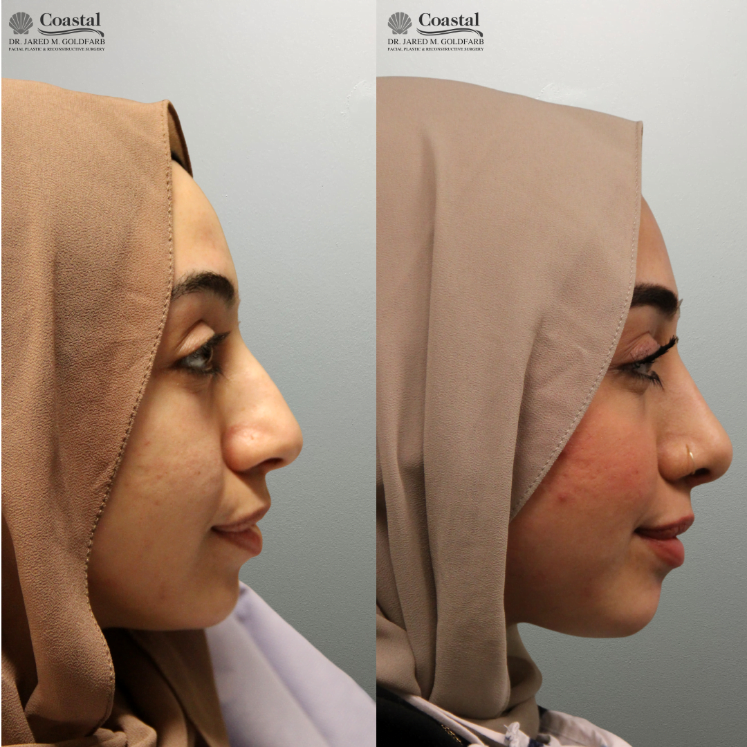 Debunking Common Misconceptions On Rhinoplasty Coastal Nj Facial Plastic
